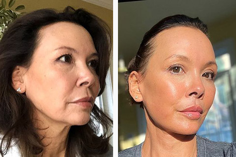 Mini Facelift | Best Mini Facelift Surgeon Dr. Andrew Jacono