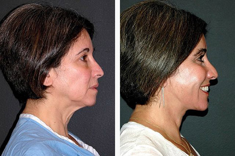 Mini Facelift | Best Mini Facelift Surgeon Dr. Andrew Jacono