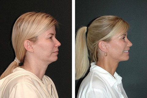 Mini Facelift | Best Mini Facelift Surgeon Dr. Andrew Jacono