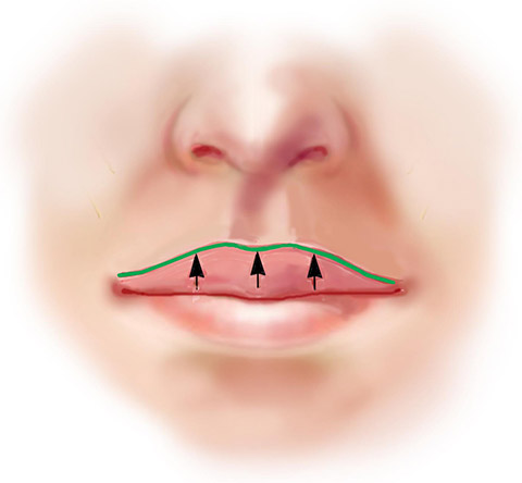 Lip Lift Techniques NYC | Lip Lift Procedures New York