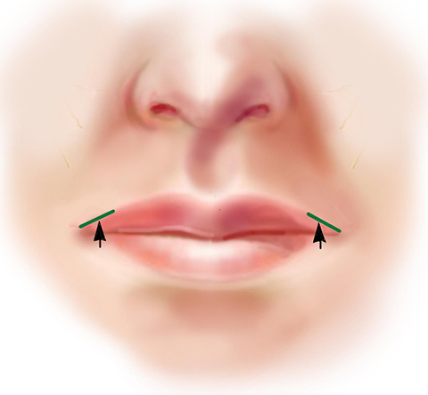 Lip Lift Techniques NYC | Lip Lift Procedures New York