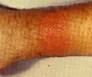 About Cigarette Burns | Healthfully