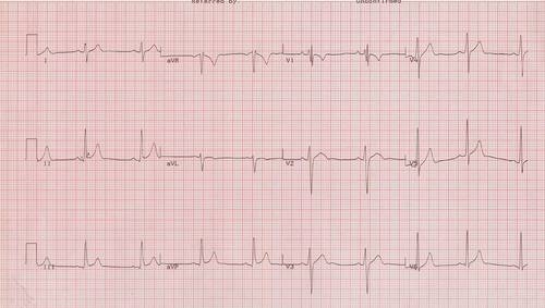 Symptoms of a Left Bundle Branch Block | Healthfully