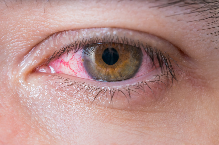 Eye Injuries