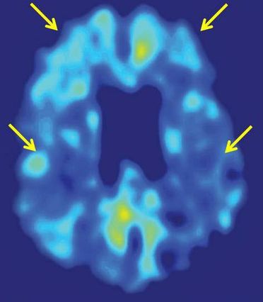 UCLA brain-imaging tool and stroke risk test help identify cognitive ...
