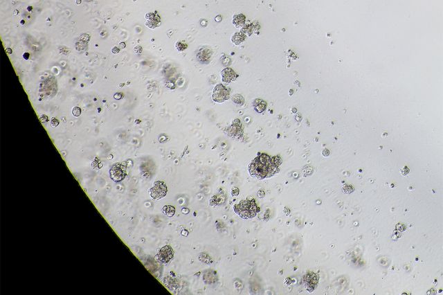 Lab-grown mini tumors could help identify personalized treatments for ...