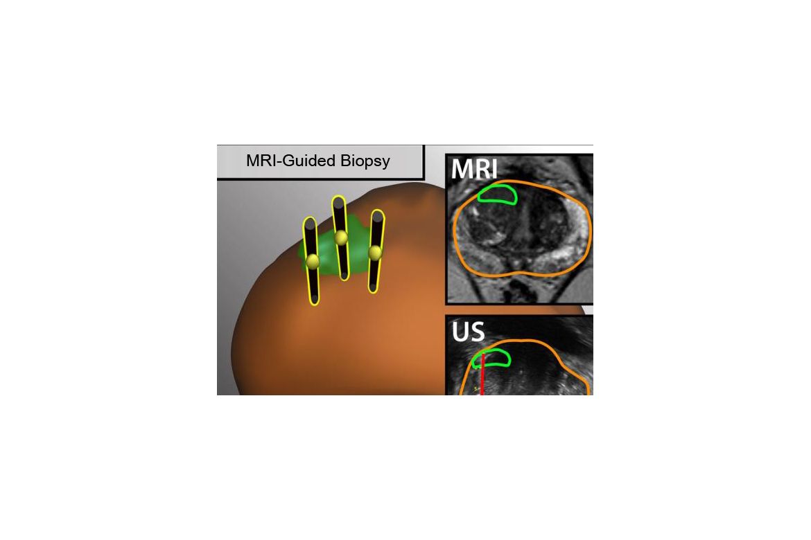 Photo | Systematic versus MRI guided biopsy | UCLA
