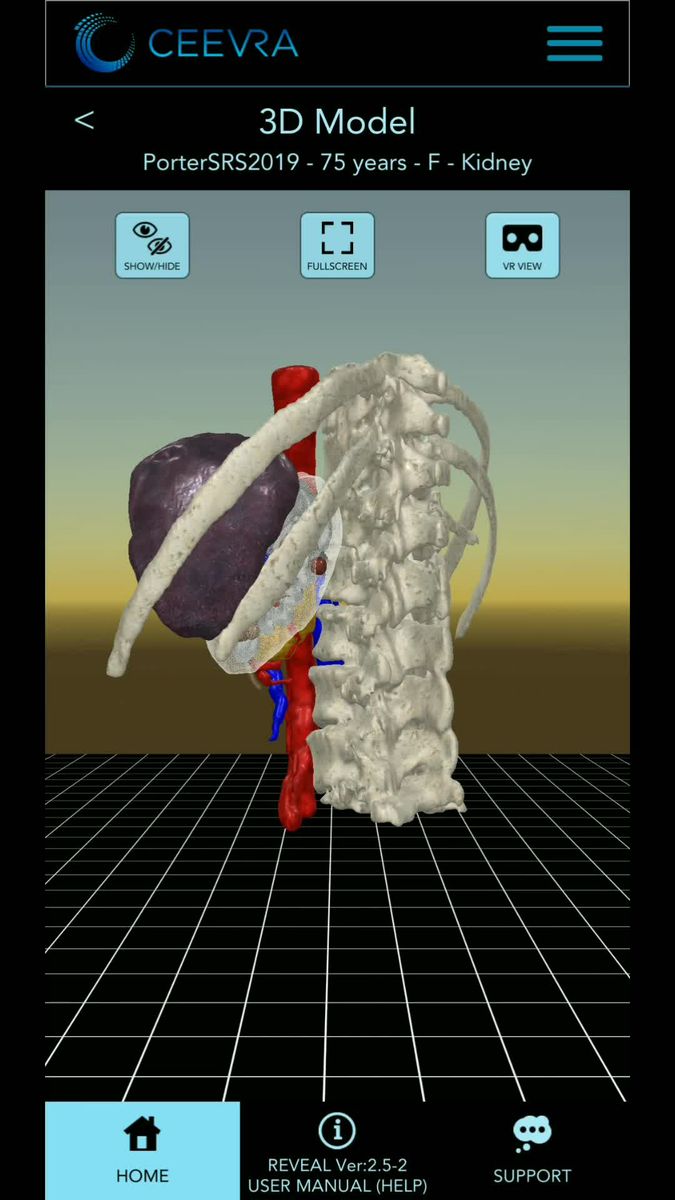 3D virtual reality models help yield better surgical outcomes | UCLA