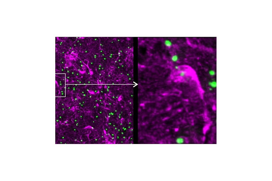 Study focuses on repair and reversal of damage caused by Huntington’s ...