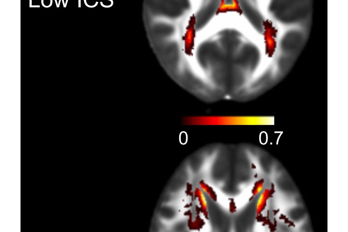 Photo | White matter damage | UCLA