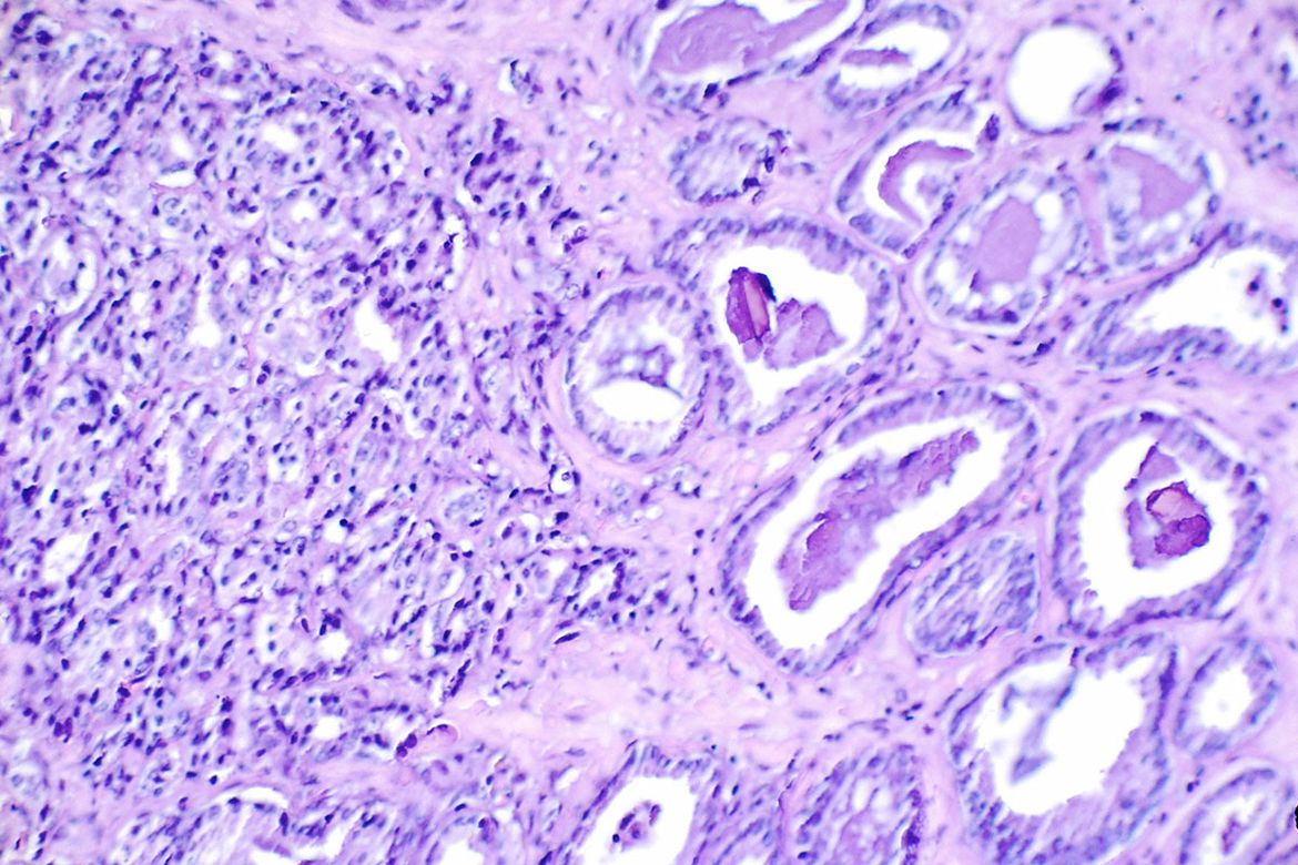 Photo | Close-up of prostate cancer cells in purple and white | UCLA