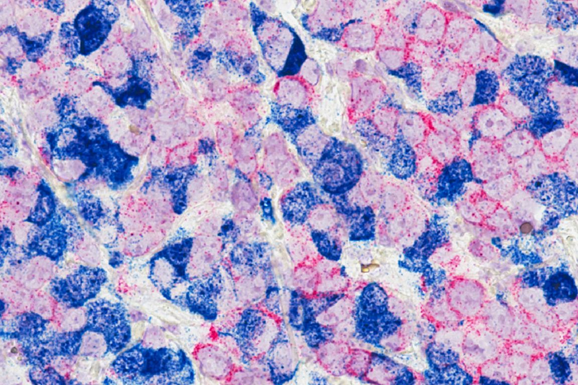 New Therapy Slashes Recurrence in Common Breast Cancer | Mirage News