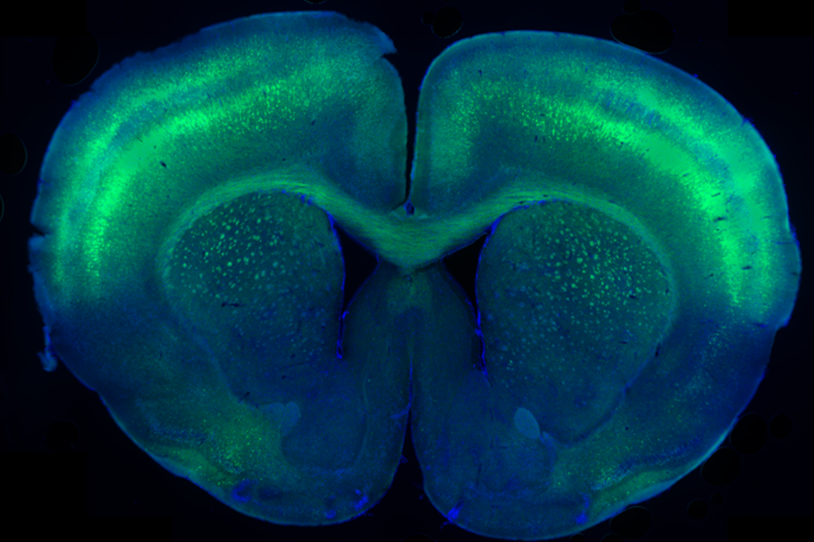 A surgeon’s second calling: Gene therapy for the brain’s energy crisis ...