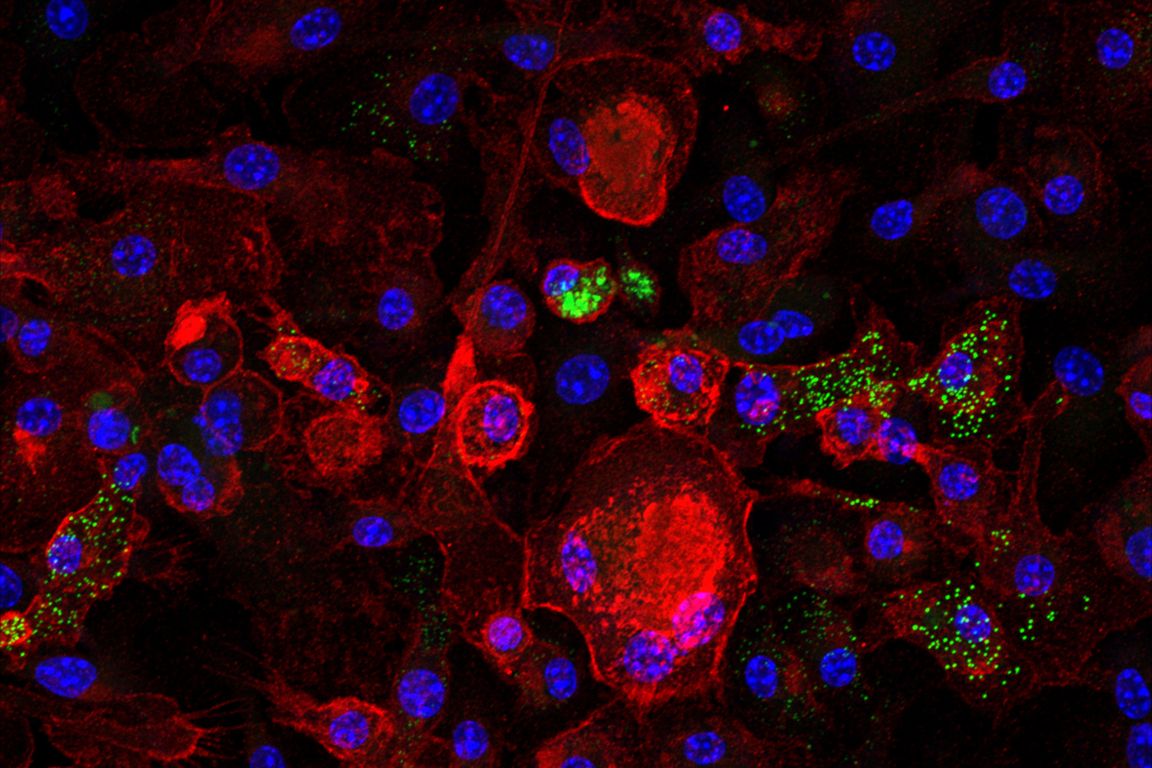UCLA scientists identify zombie immune cells as a driver of fatty liver ...