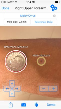 OHSU releases Mole Mapper ResearchKit app to track potential skin cancers | OHSU News