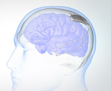 Brain implant at OHSU successfully controls both seizures and OCD ...