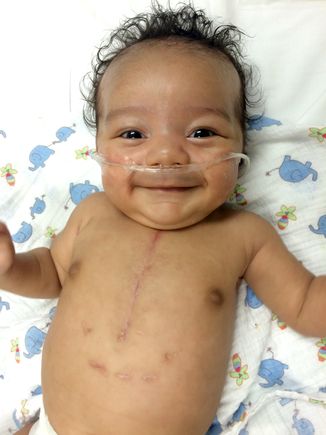 Managing congenital heart defects | OHSU News