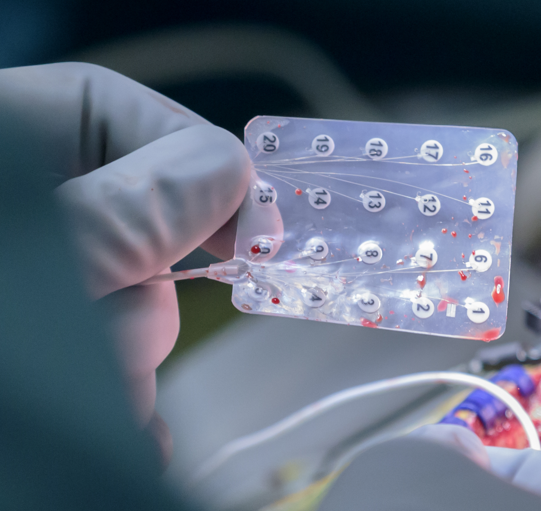 Patients awake, taking active role during brain surgery | OHSU News