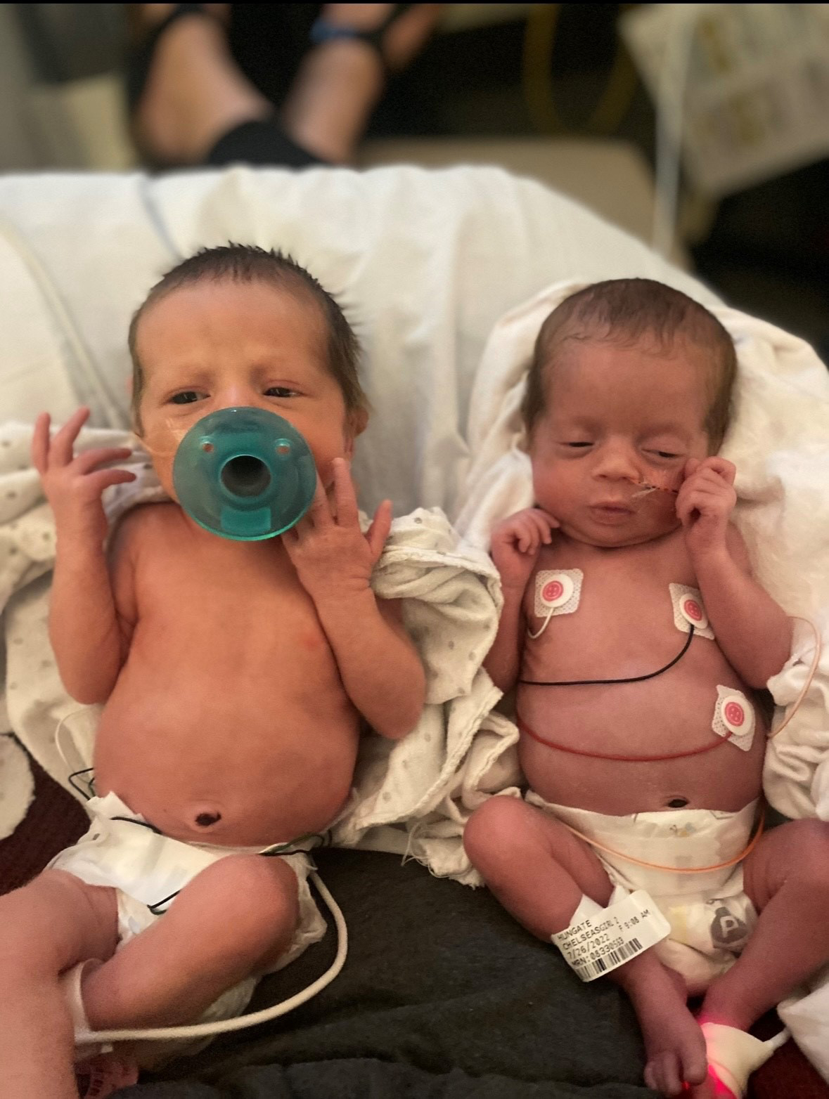 OHSU fetal surgeons save twins facing life-threatening condition | OHSU ...