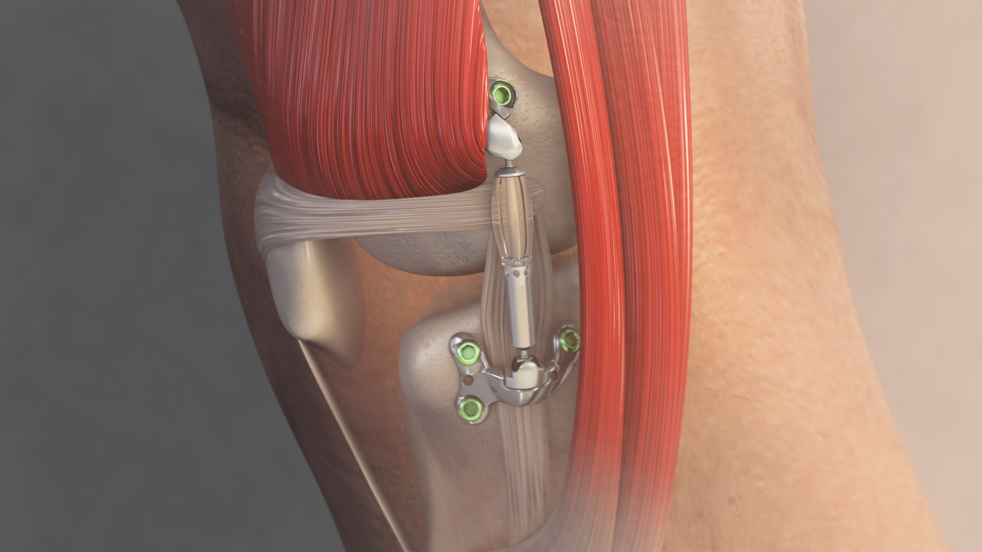 OHSU clinical trial validates new, FDA-cleared technique for knee ...
