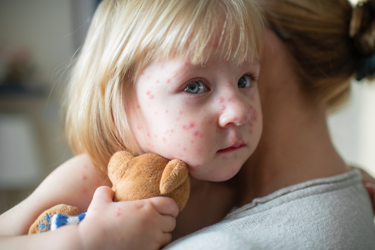 Your child has a rash. 7 key tips for how to handle it. | Novant Health ...