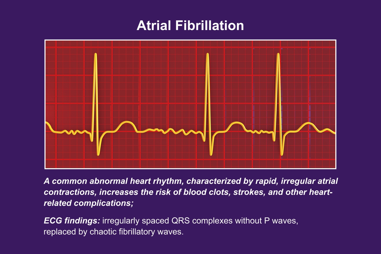 Pulsed-Field Ablation:A less risky approach to a healthier heartbeat ...