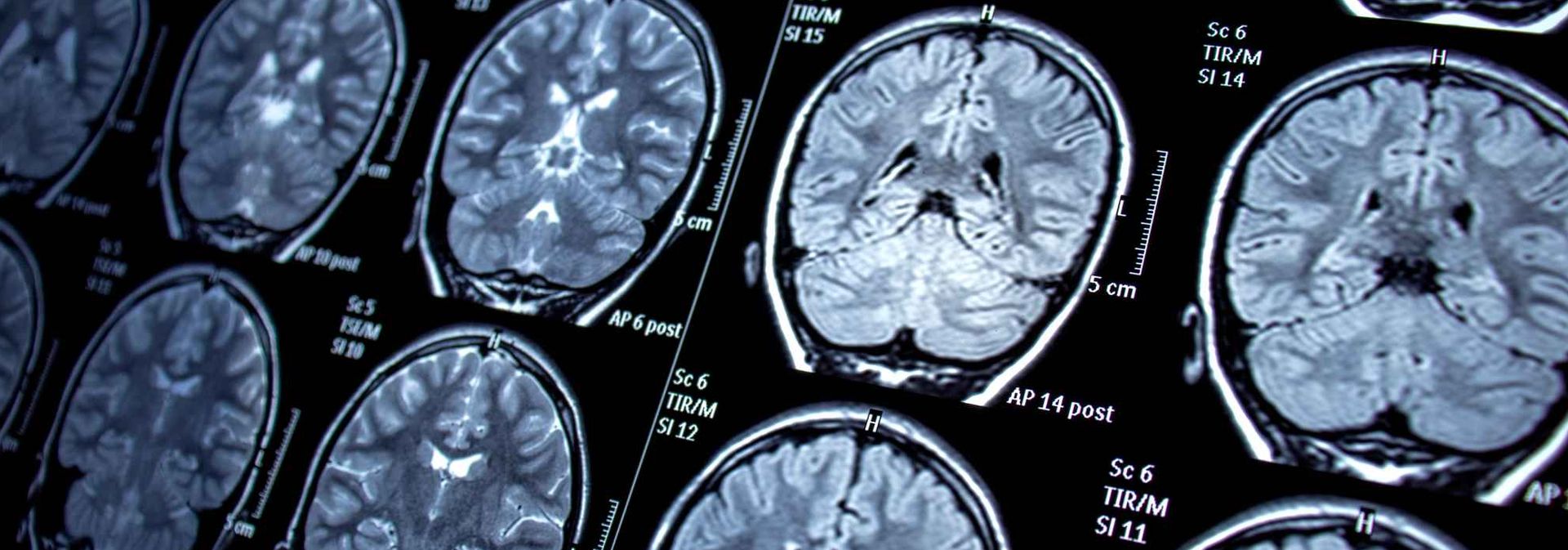 Understanding the Link Between HIV and Brain Health | URMC Newsroom