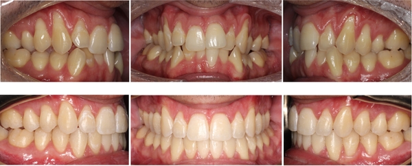 Innovative Procedure Paves Way for Safer Orthodontics in Patients with ...