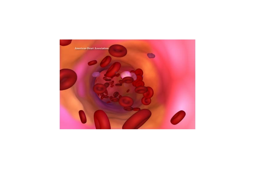 Video | Blockage forming - Atherosclerosis | American Heart Association