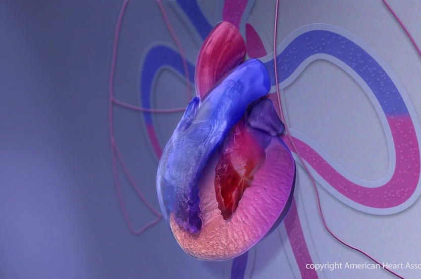 Video | Cardiomyopathy animation | American Heart Association