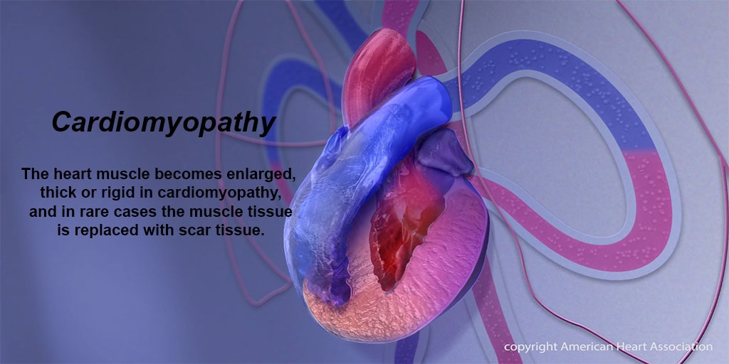 Photo Cardiomyopathy Infographic American Heart Association Photo Cardiomyopathy Infographic American Heart Association