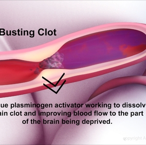 AHA/ASA Medical Graphics and Illustrations | American Heart Association