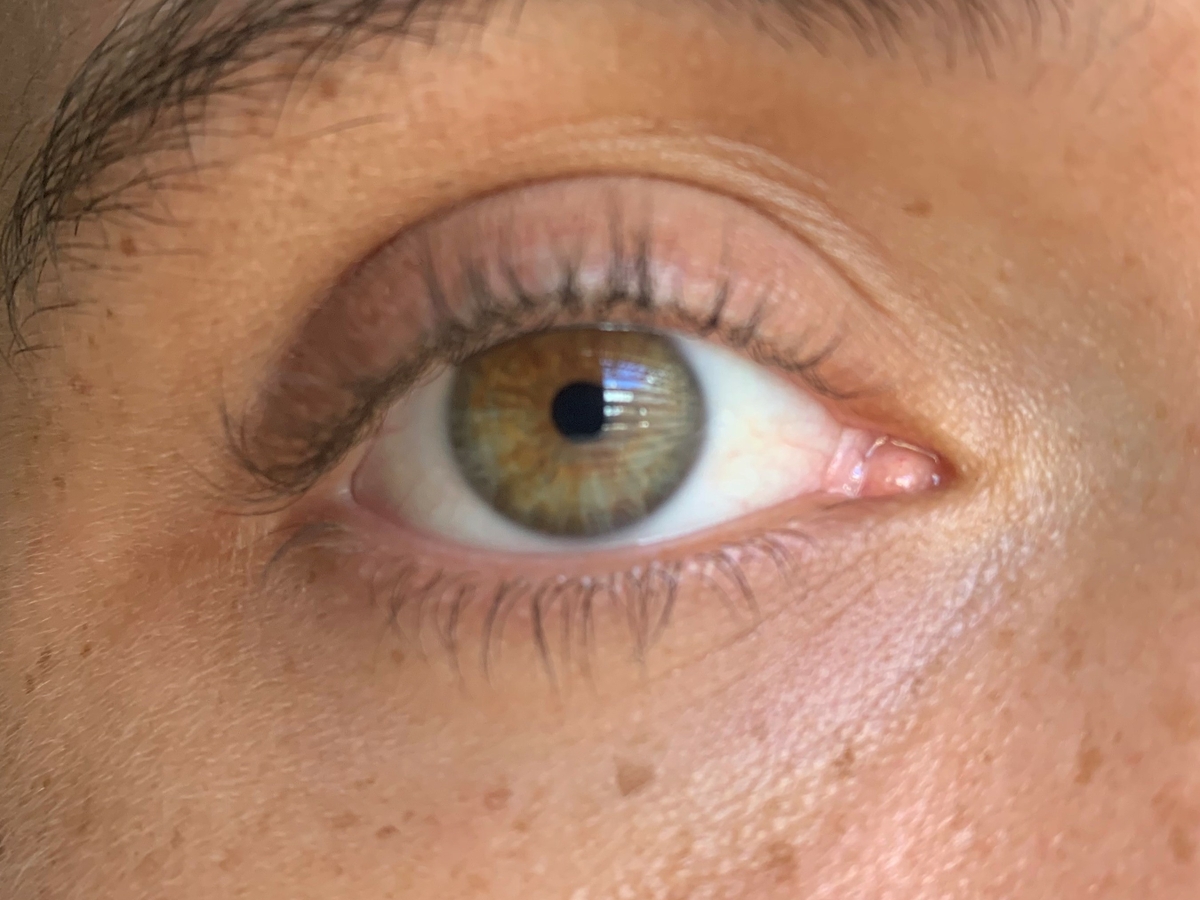 Stroke Affecting The Eye Requires Immediate Treatment Can Signal Stroke Affecting The Eye Requires Immediate Treatment Can Signal