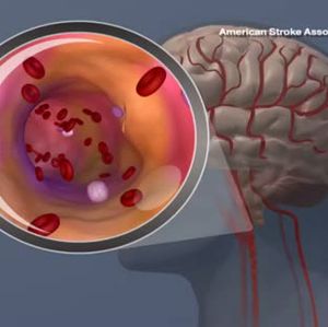 AHA / ASA Animations | American Heart Association