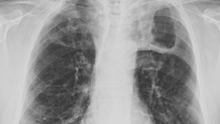 Tuberculose (ganglionar, pulmonar): o que é, sintomas, causa