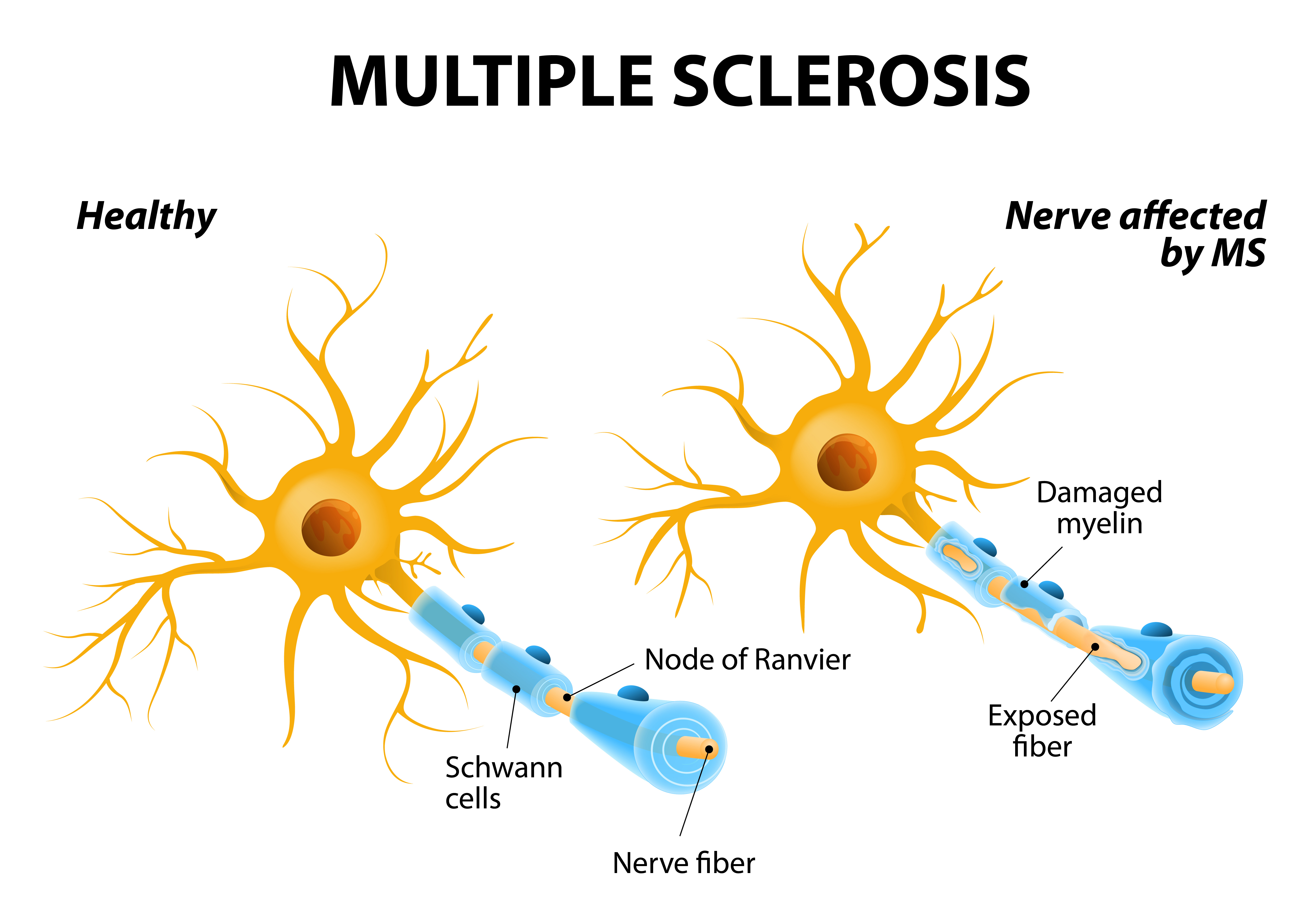 About Multiple Sclerosis ZyVersa Therapeutics Inc 