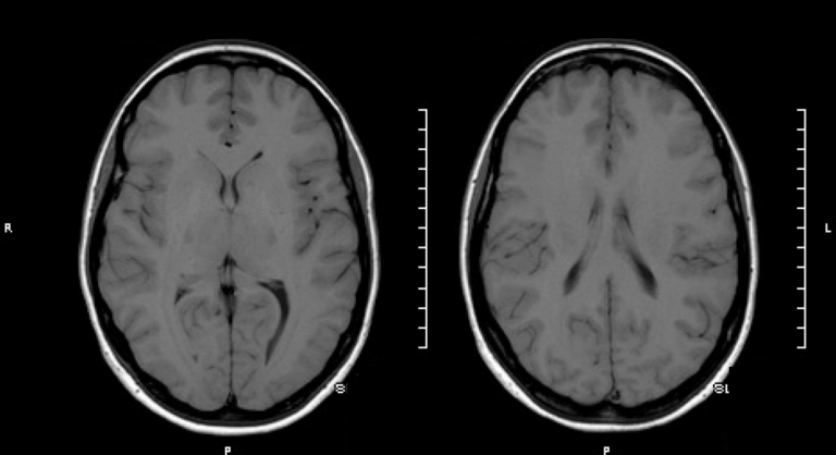 Idiopathic intracranial hypertension doc – Bobby Jones CSF