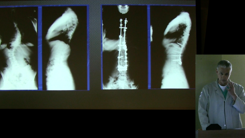 The Relationship Between Chiari Malformation, Syrinx (Syringomyelia ...