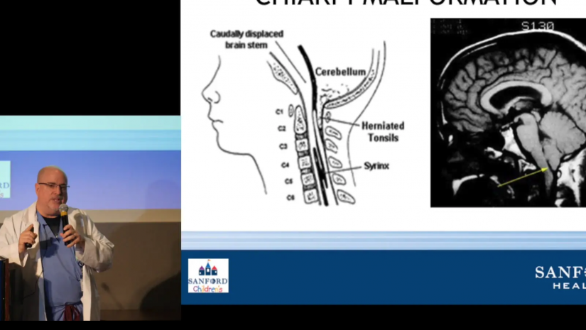 Chiari and Chiari Concerns – Bobby Jones CSF
