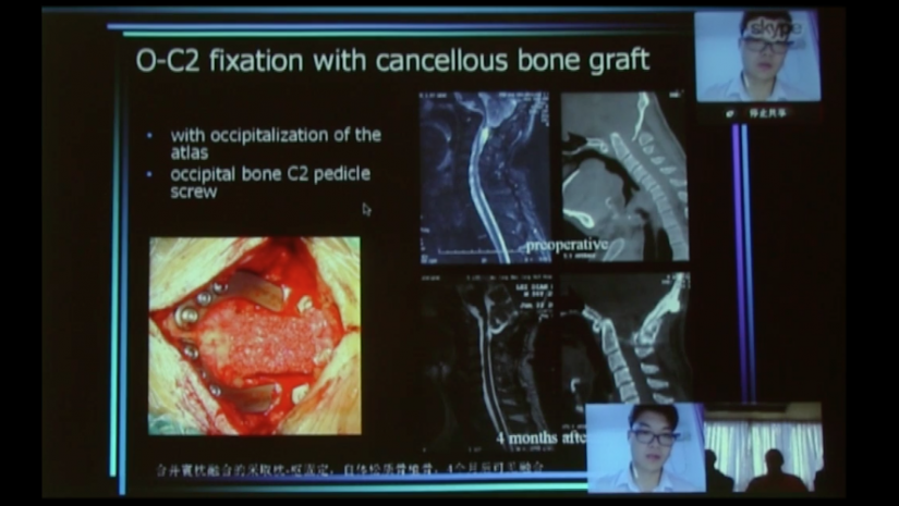 Craniocervical Instability with Chiari Malformation – Bobby Jones CSF