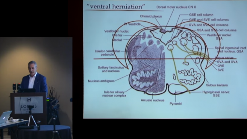 Defining Unique Chiari Classifications – Bobby Jones CSF