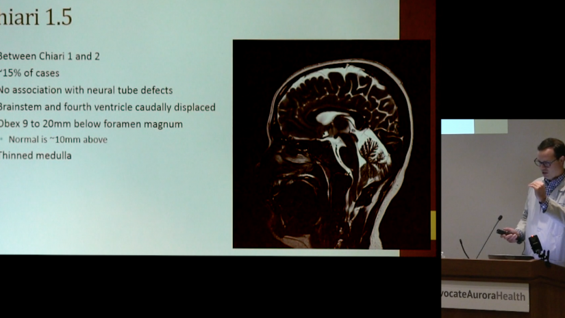 Chiari Malformation & Chiari 1.5: An Update – Bobby Jones CSF