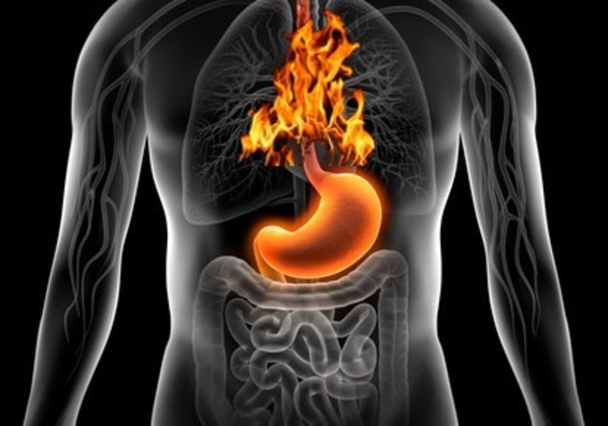 Understanding Acid Reflux Disease: Causes, Symptoms, and Effective ...