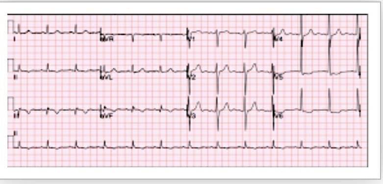 Silent Coronary Artery Disease
