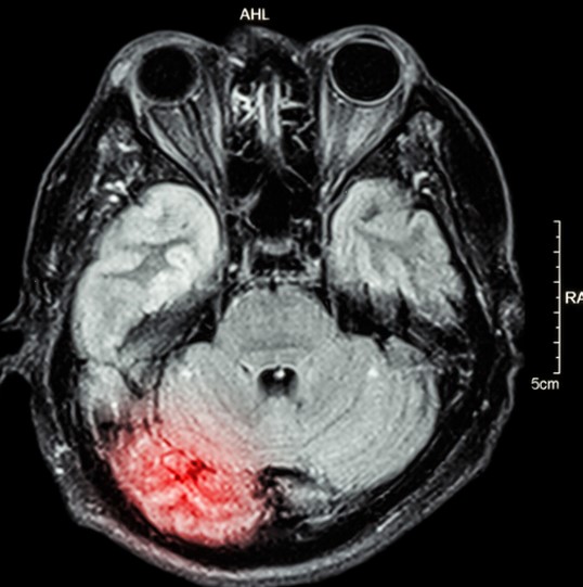 POST TRAUMATIC HEADACHES | DC Hours