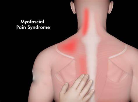 Myofascial Pain Syndrome | DC Hours