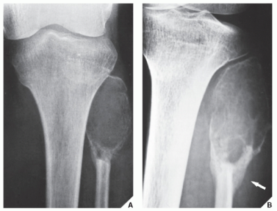 Radiology of Malignant Bone Tumor | DC Hours