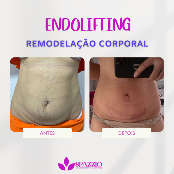ENDOLASER/ENDOLIFTING - Spazzio
