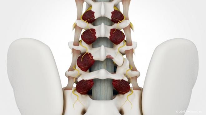 DK Global | Case Feature | (VIDEO) $1.5M Settlement for Complex Spinal Case