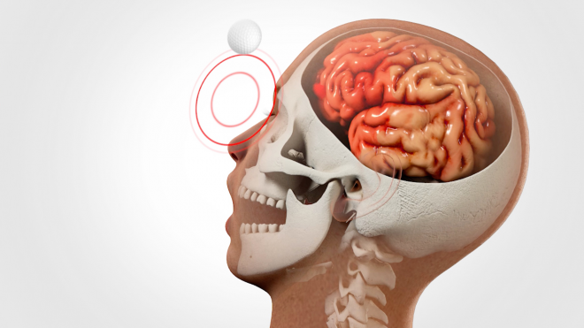 DK Global | Case Feature | 3D Surgical Animation to Demonstrate Brain ...